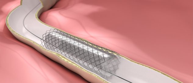 Interventional cardiac procedures - Northern Arizona Healthcare